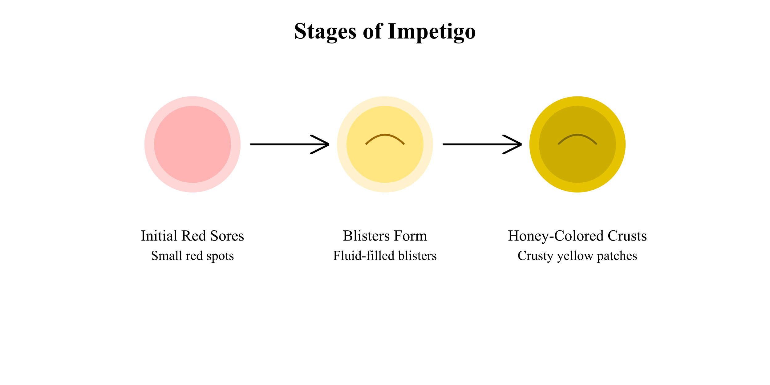 Impetigo – Skin Rash - Orange Pharmacy